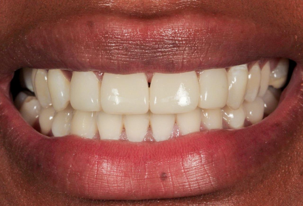 Composite Bonding London | From £250 | Colindale & Rochester