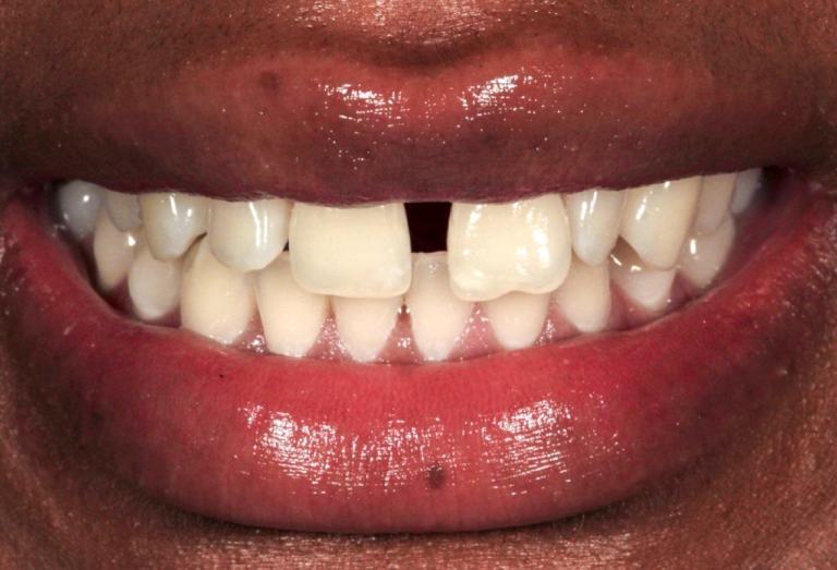 Composite Bonding London | From £250 | Colindale & Rochester