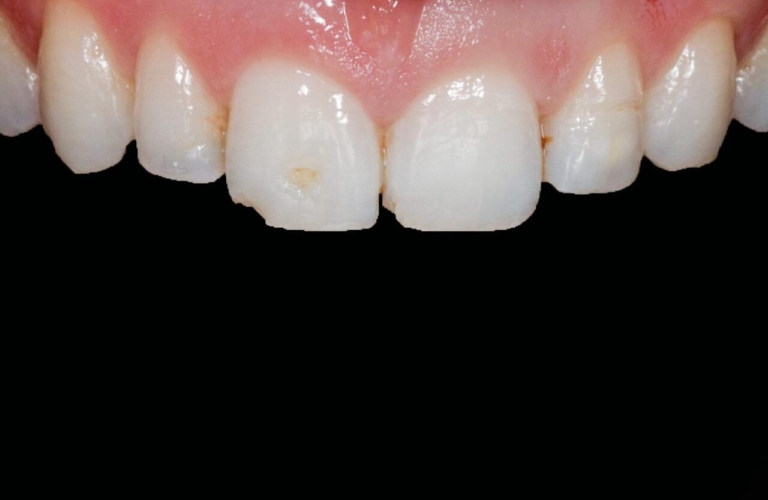 Composite Bonding London | From £250 | Colindale & Rochester