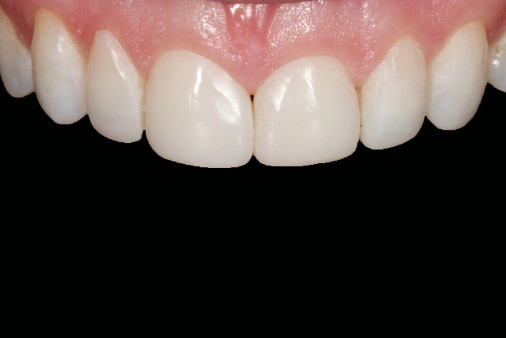 Composite Bonding London | From £250 | Colindale & Rochester